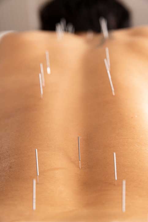 Therapeutic Massage & Chinese Medicine Acupuncture in Raleigh